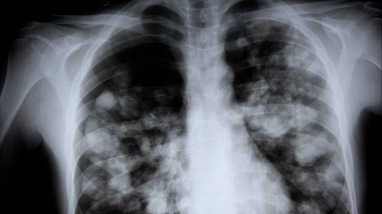 Pneumonia Definition and Causes — Helpful