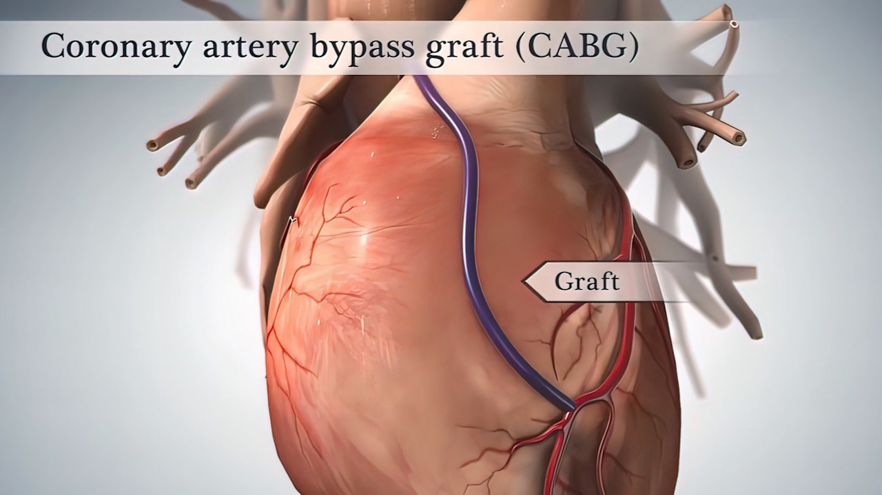 Definición de injerto de derivación aortocoronaria (CABG) — Helpful