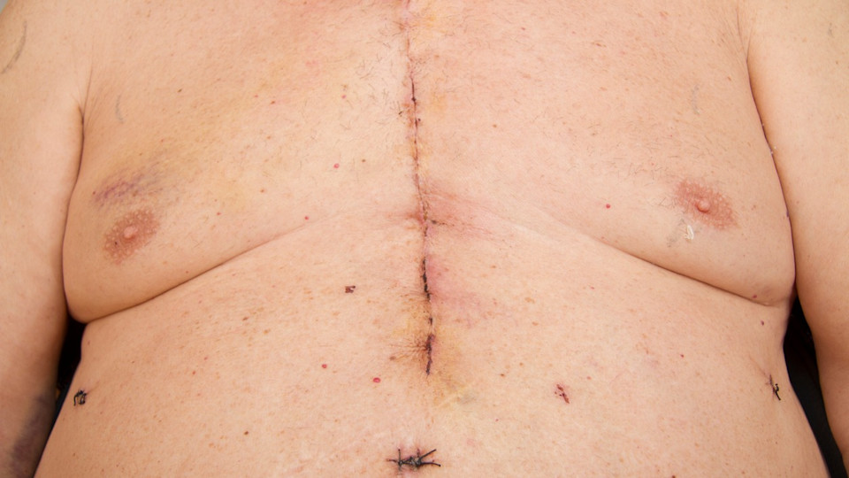 Results of Coronary Artery Bypass Graft (CABG) — Helpful