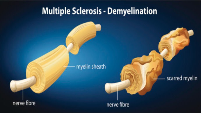 Late Onset Multiple Sclerosis (MS) — Helpful