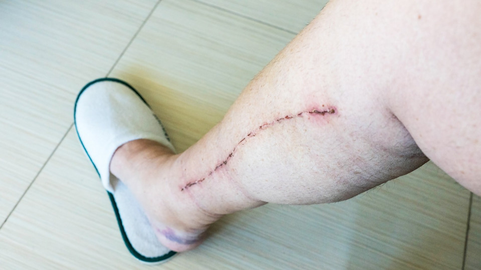 Definición de injerto de derivación aortocoronaria (CABG) — Helpful