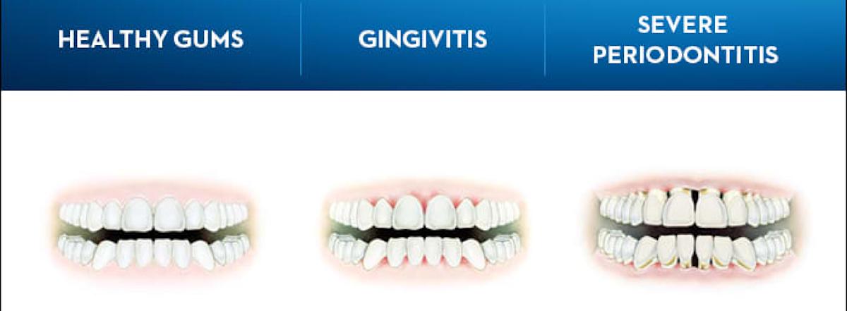 What is Gingivitis: Symptoms, Causes, and Treatments | Crest CA