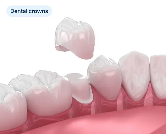 How to fix a chipped tooth | Aspen Dental