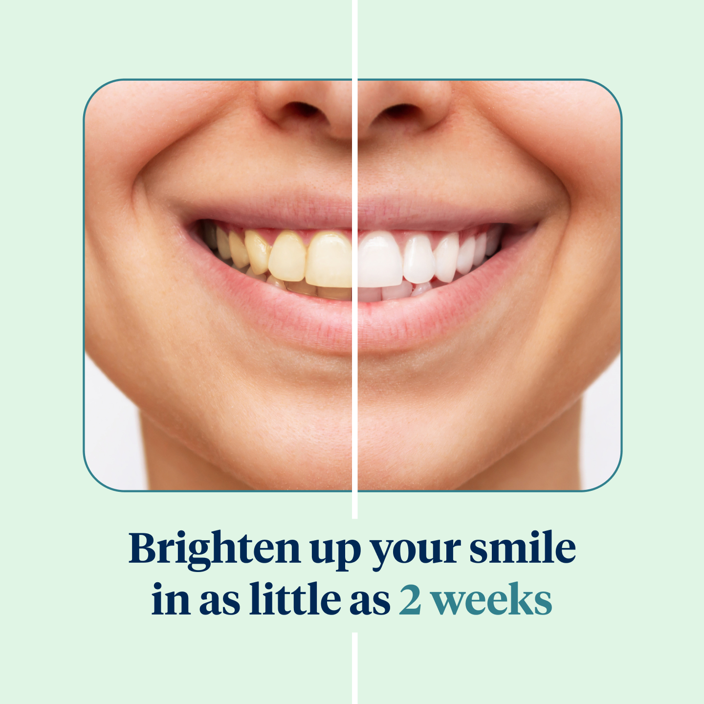 Teeth Whitening - The Best Way to Whiten Your Teeth