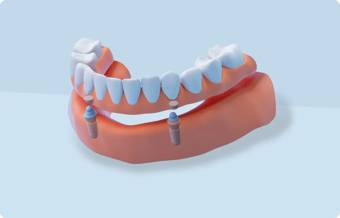 Implant dentures (also known as implant overdentures): Procedure guide ...