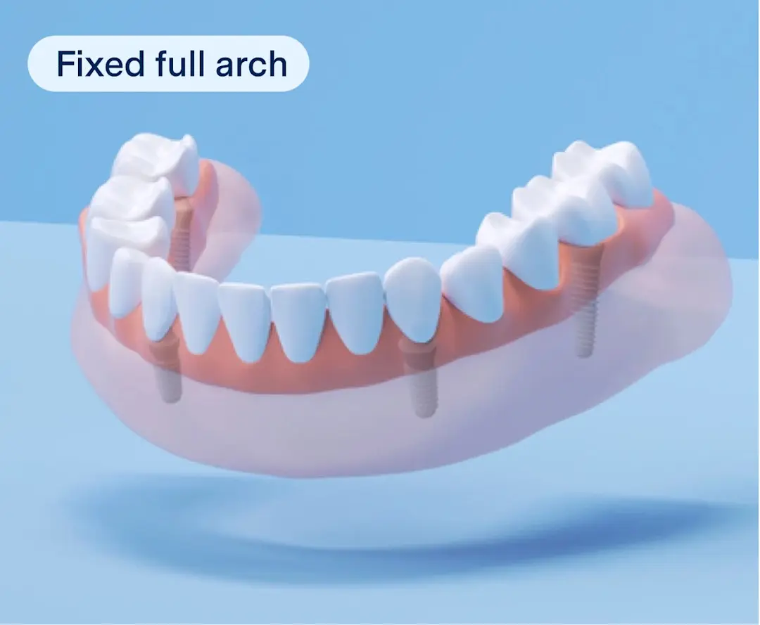 Are permanent dental implants right for me? Benefits and risks | Aspen ...