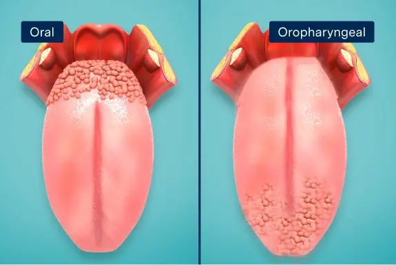 Tongue Cancer: Symptoms, Causes, and Treatment | Aspen Dental