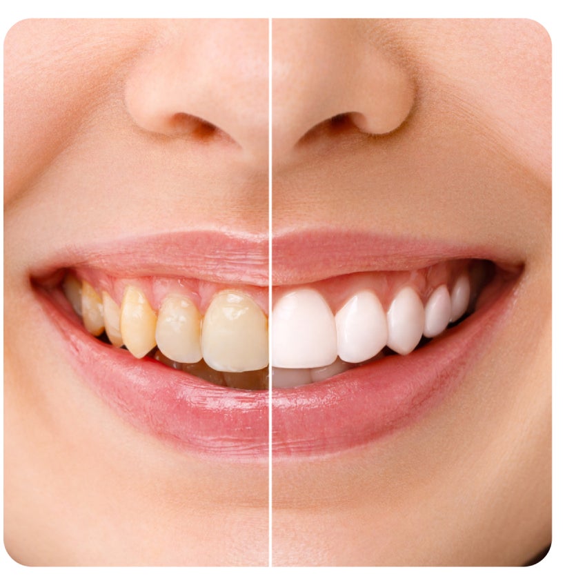Cosmetic Dentistry in Fayetteville, NC | Aspen Dental