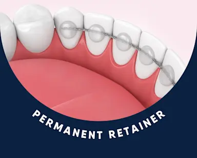 The pros and cons of a permanent retainer | Aspen Dental