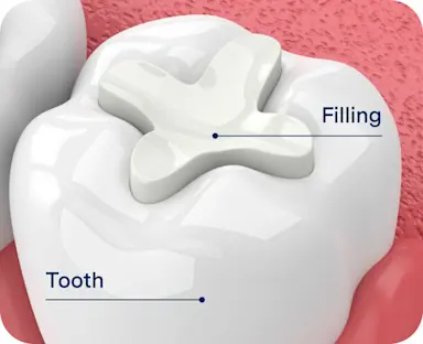 Composite fillings: your complete guide | Aspen Dental