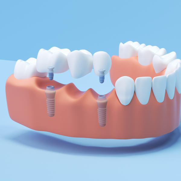 Dental Implants in Ft. Lauderdale, FL (Harbor) | Aspen Dental