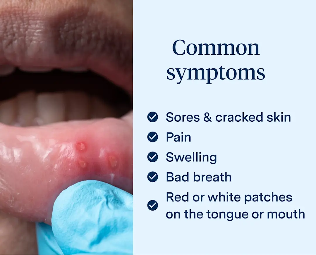 Denture stomatitis: causes, treatment and prevention | Aspen Dental