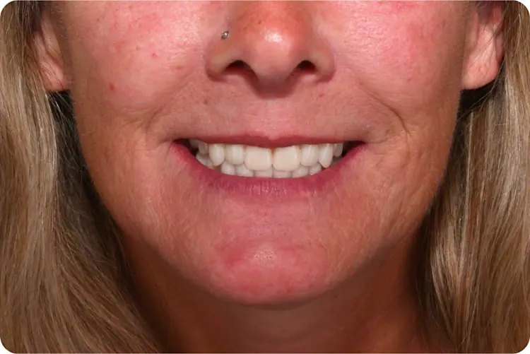 What to know about permanent vampire fangs | ClearChoice