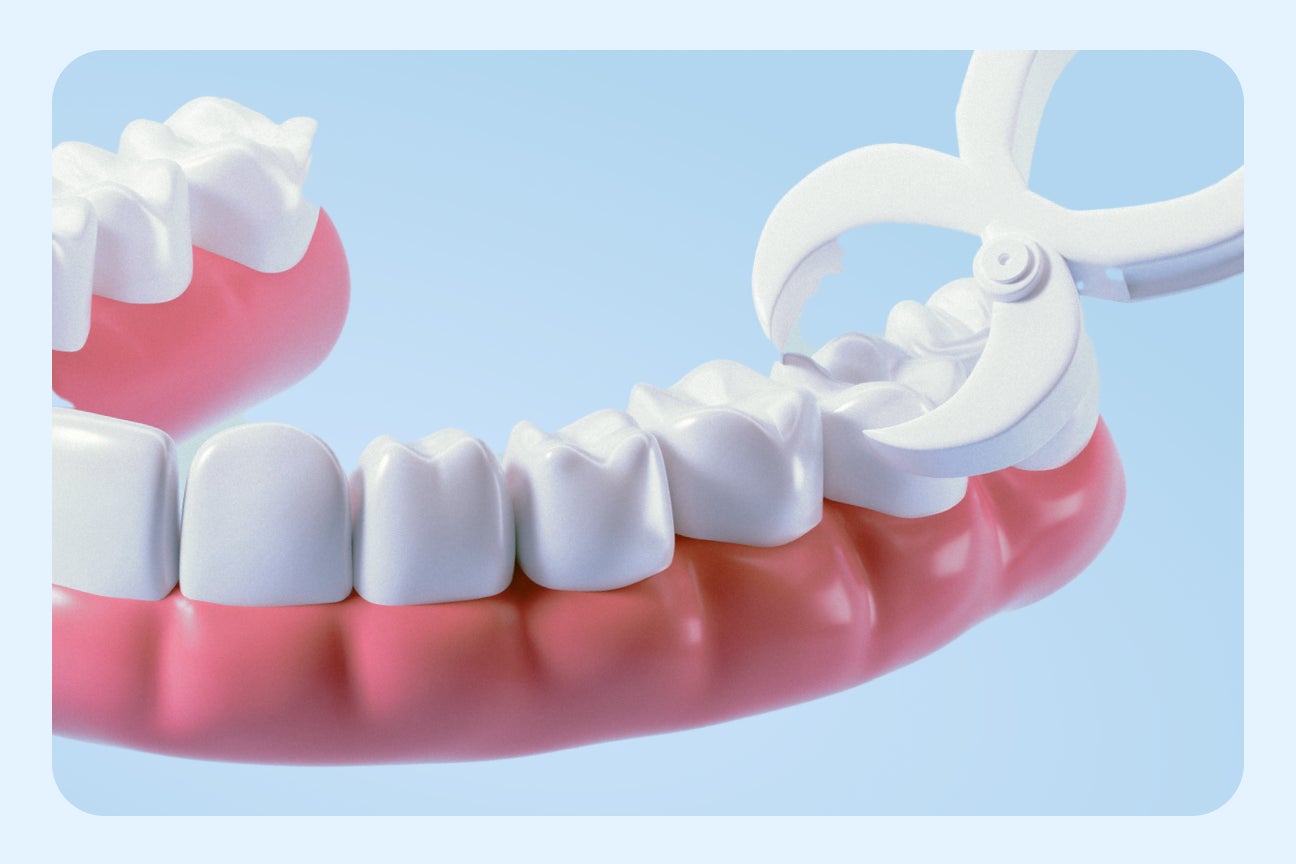 Tooth Extraction in Santa Maria, CA | Aspen Dental