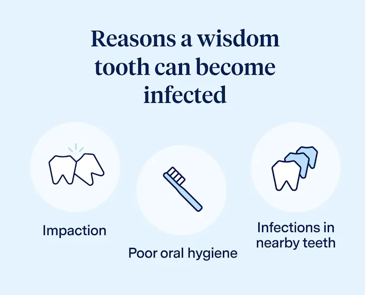 Wisdom tooth infection: symptoms, causes, and treatments | Aspen Dental