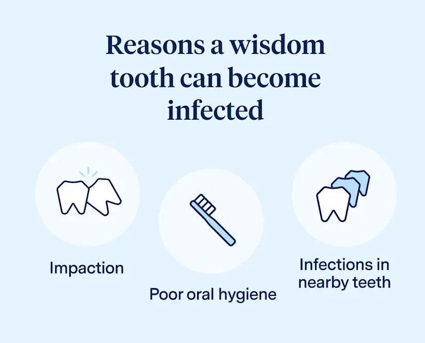 Wisdom tooth infection: symptoms, causes, and treatments | Aspen Dental