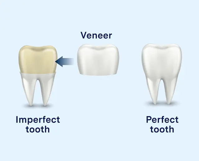 Teeth Bonding vs Veneers: Compare Benefits & Costs | Aspen Dental