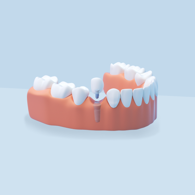 Single Tooth Dental Implants for Lasting Confidence | ClearChoice