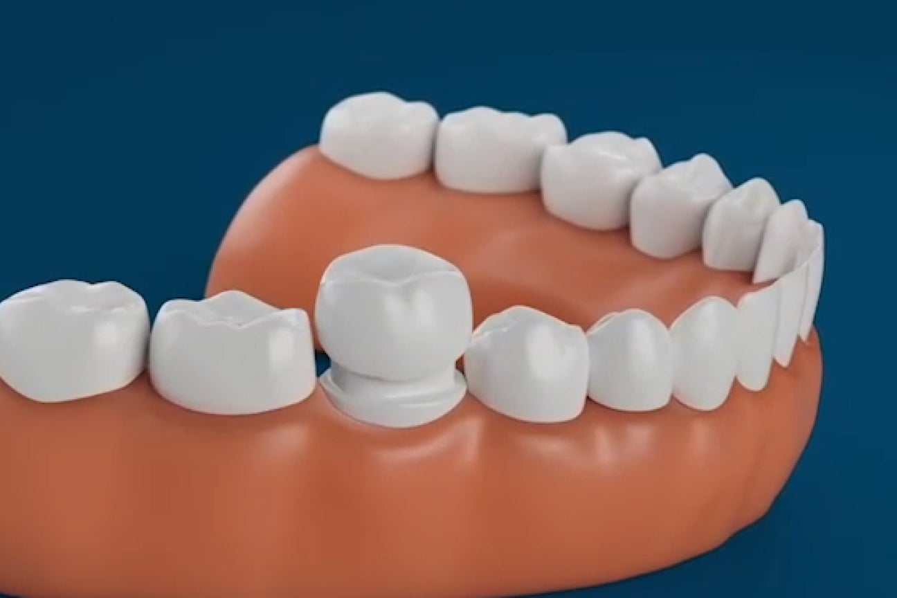 half crown dentistry