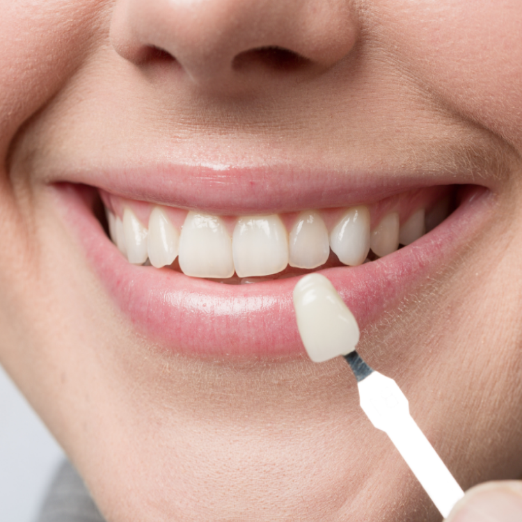 Dental Veneers in Oviedo, FL | Veneers Near Me | Aspen Dental