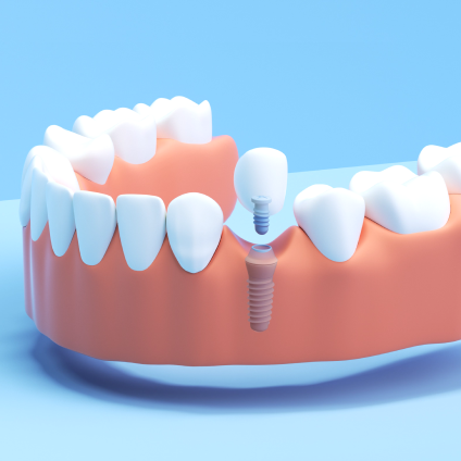 Dental Implants: Tooth Replacement Solution | Aspen Dental