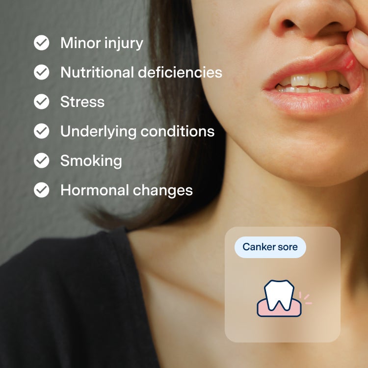 Canker Sore Medicine Debacterol (Pearson) | Dental Product | Pearson