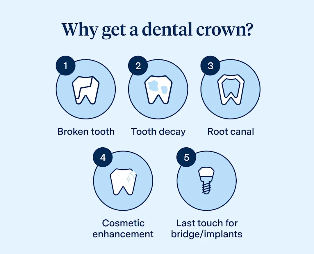How long do dental crowns last? | Aspen Dental