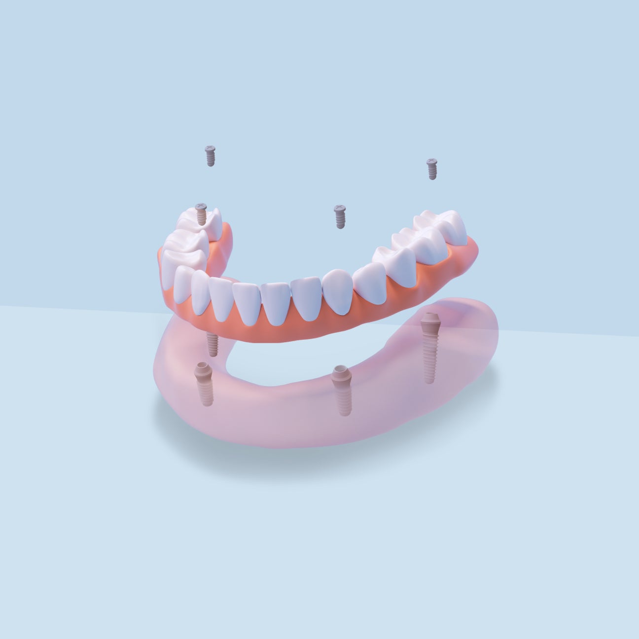 Full Mouth Implants & Dental Implants Services Costs | ClearChoice