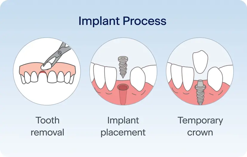 Can I get a tooth pulled and a dental implant the same day? | ClearChoice