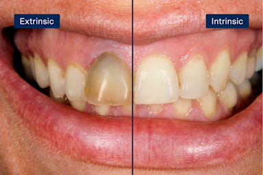Types of teeth stains and how to remove them | Aspen Dental