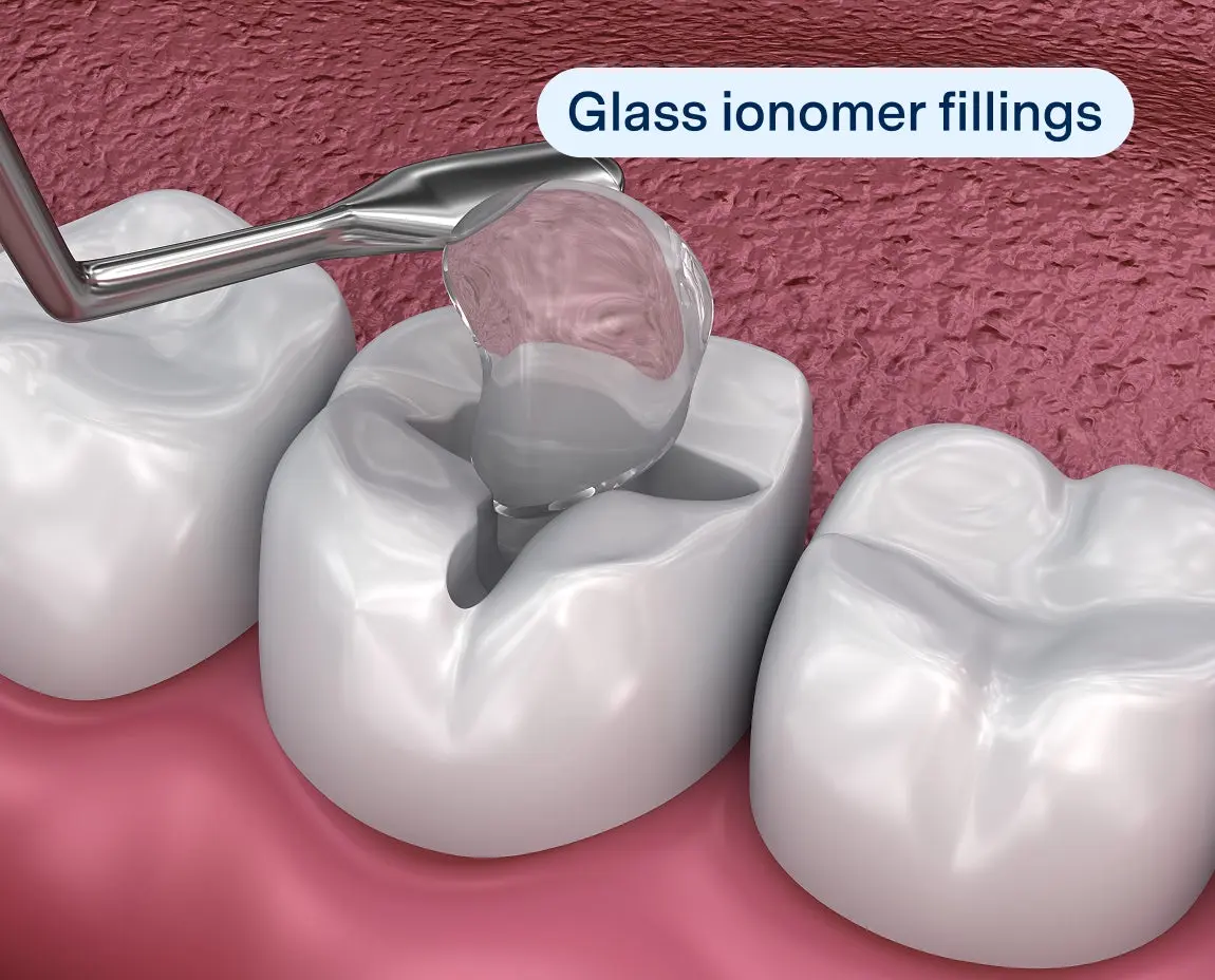 5 different types of dental fillings | Aspen Dental