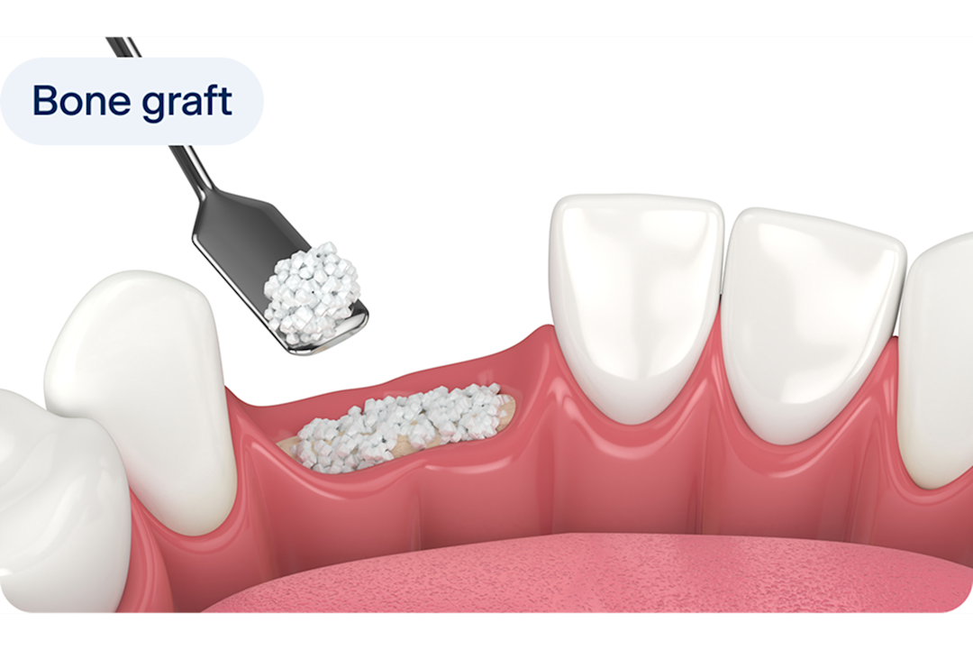 Bone graft for dental implants: what it is, why you may need one, and ...
