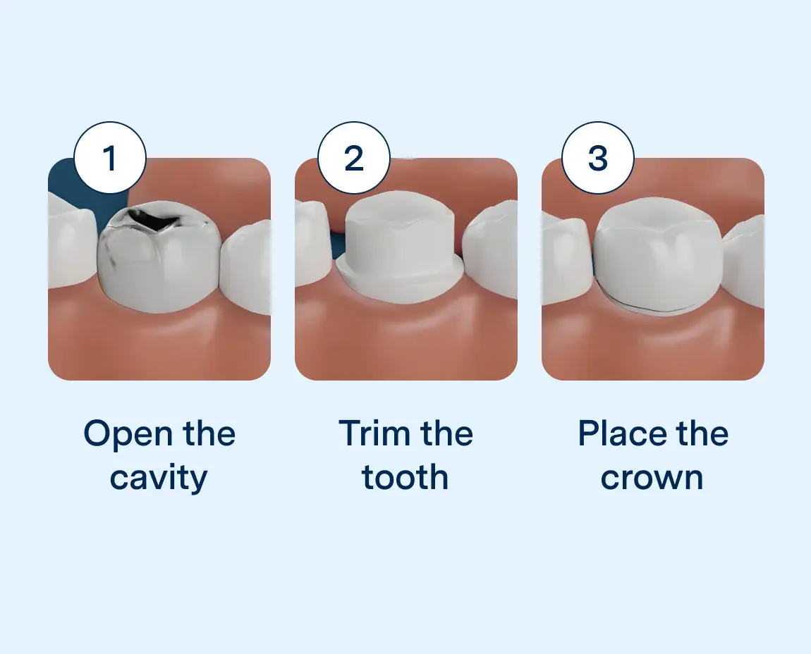 Dental crown procedure explained: what you need to know | Aspen Dental