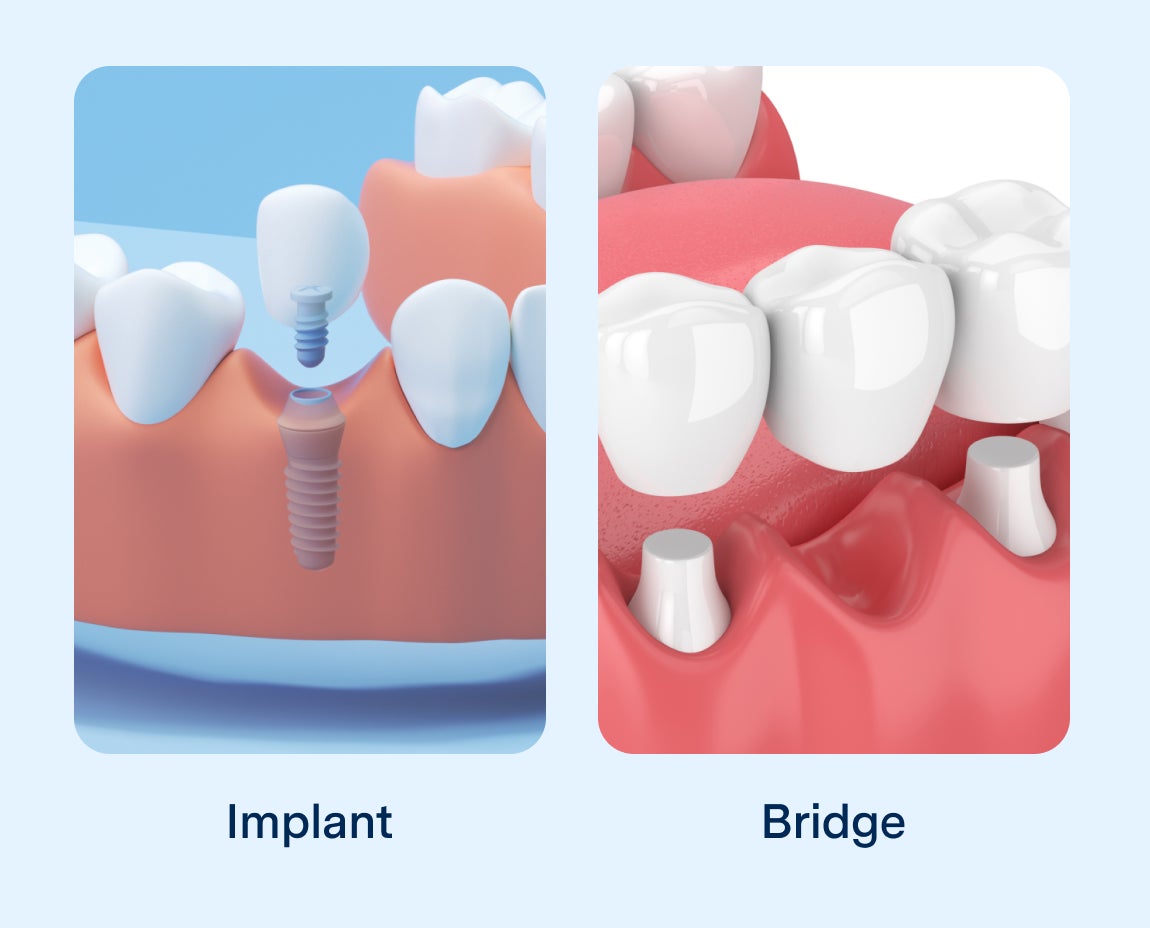 Complete Guide to Partial Dentures: Types, Benefits, and Care Tips