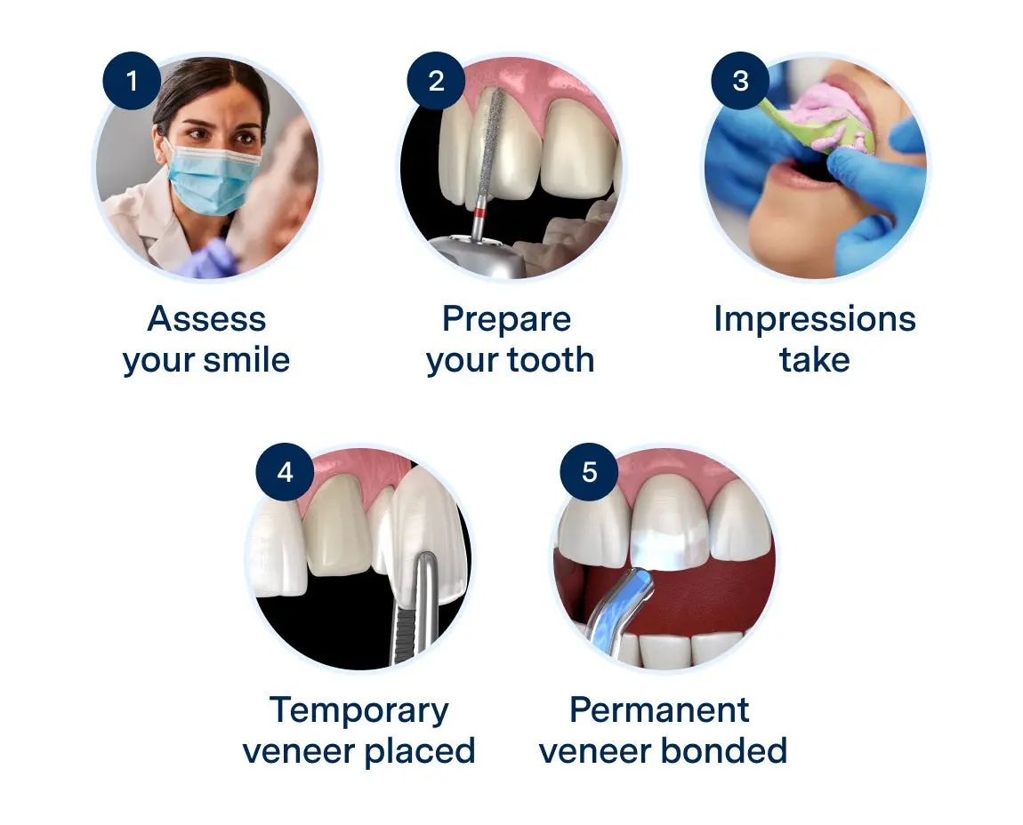 Teeth Bonding vs Veneers: Compare Benefits & Costs | Aspen Dental