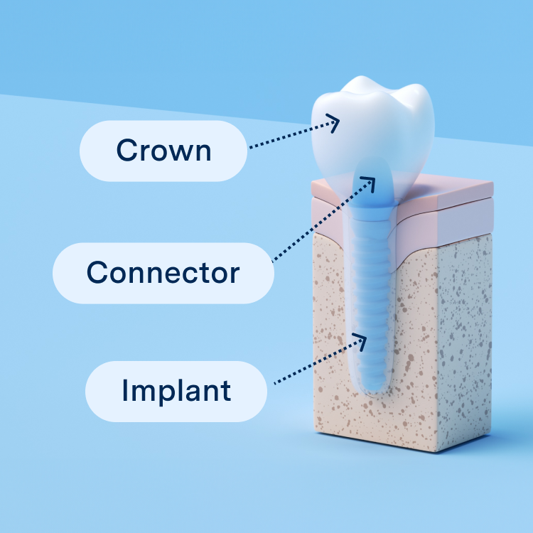 Dental Implants: Tooth Replacement Solution | Aspen Dental