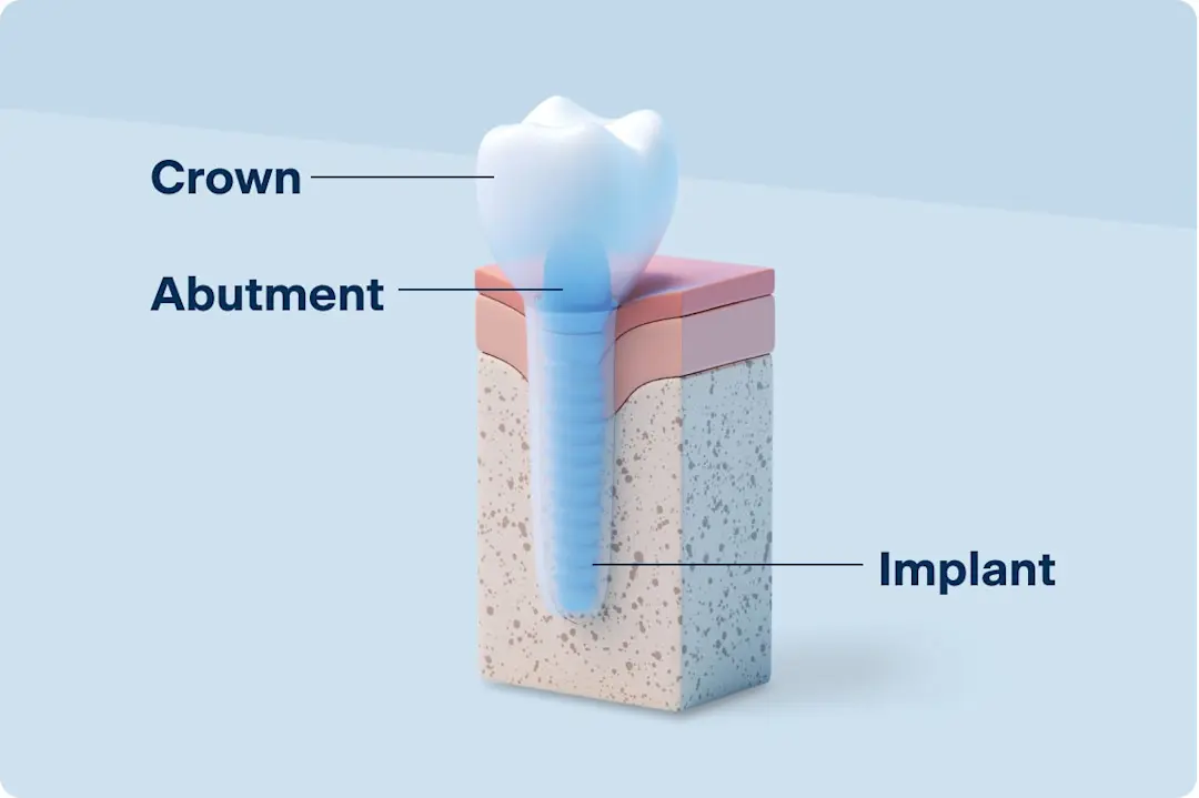 Dental implant crowns: Understanding the types and procedure | ClearChoice