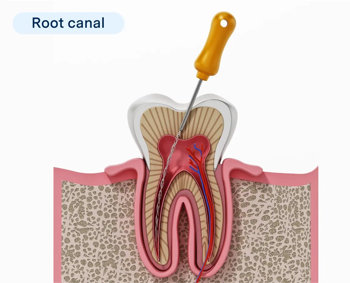 How long does a root canal last? | Aspen Dental