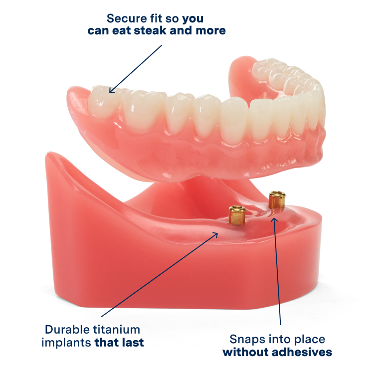 Dental Implants: Tooth Replacement Solution | Aspen Dental