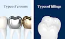 Dental crown vs filling | Aspen Dental