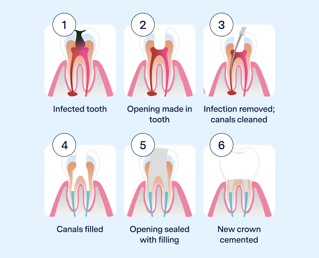 How Long Does a Root Canal Take | Aspen Dental