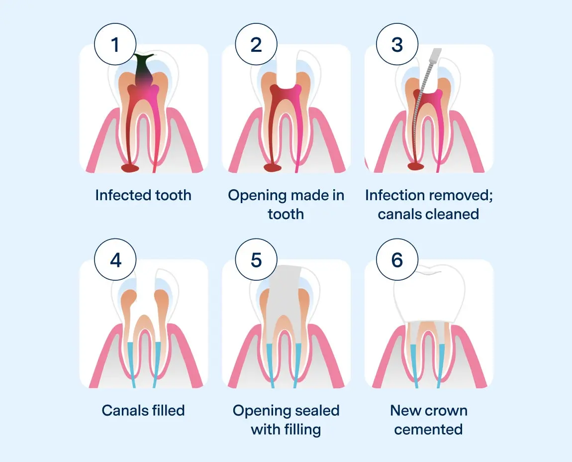 How Long Does a Root Canal Take | Aspen Dental