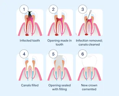 How Long Does a Root Canal Take | Aspen Dental