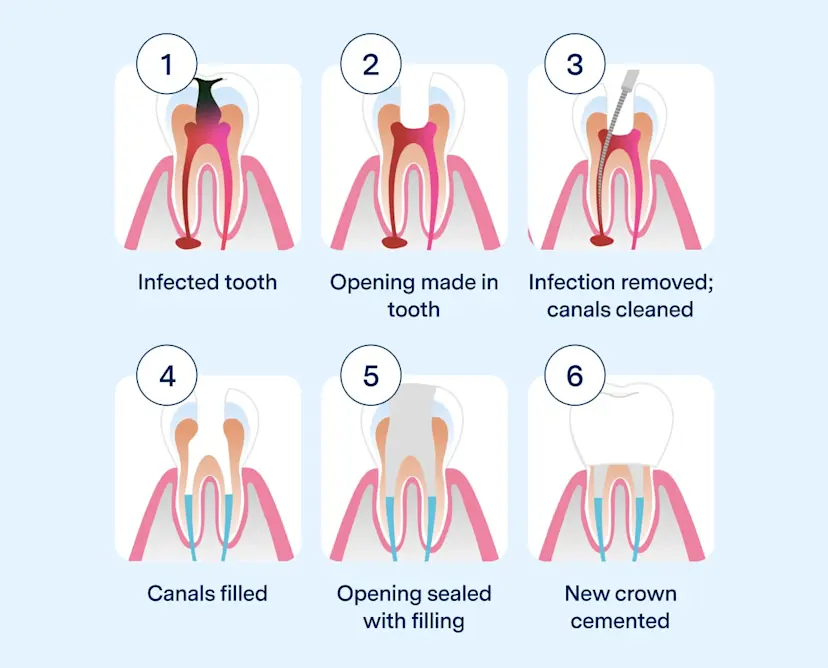 How Long Does a Root Canal Take | Aspen Dental