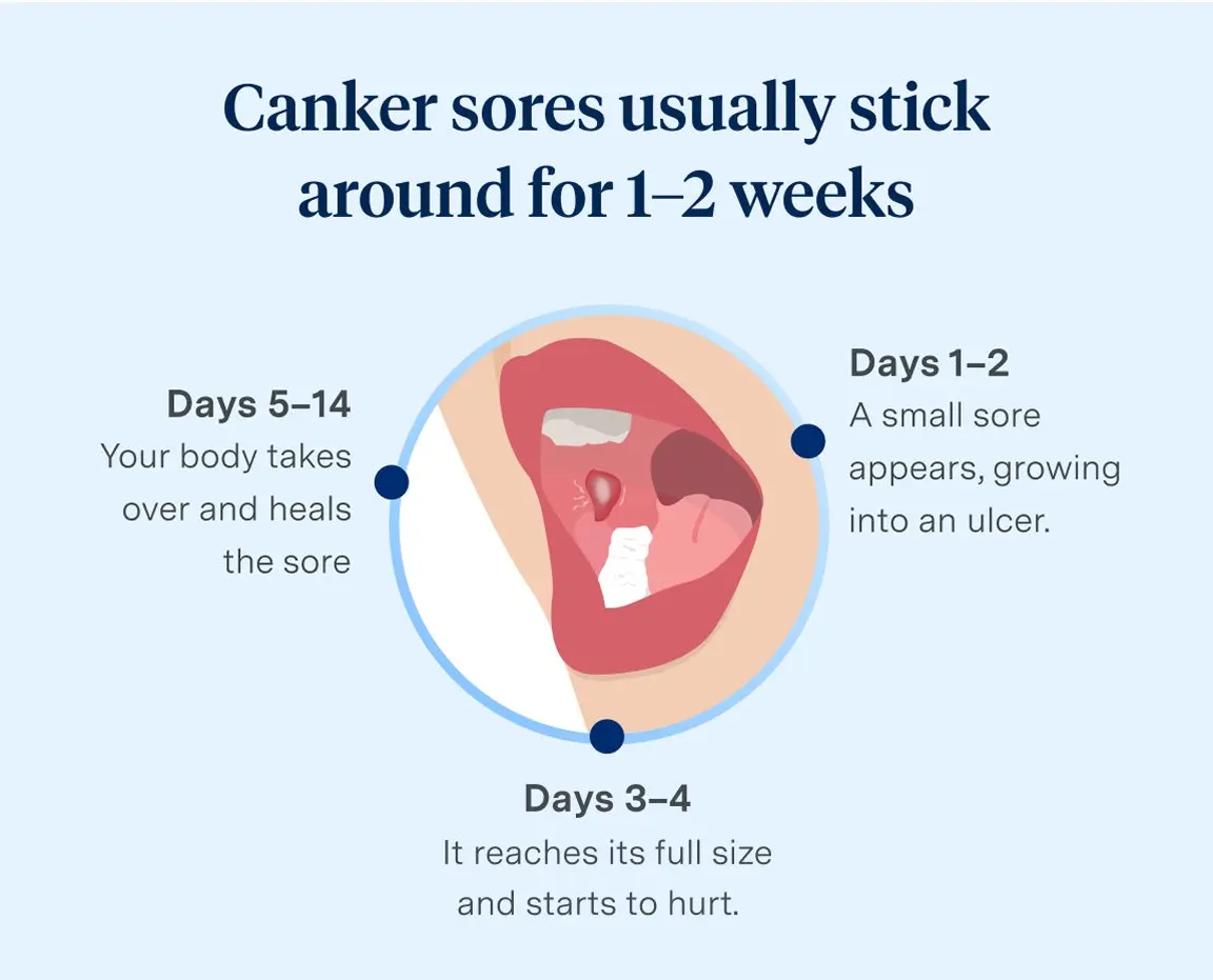 How to get rid of canker sores | Aspen Dental