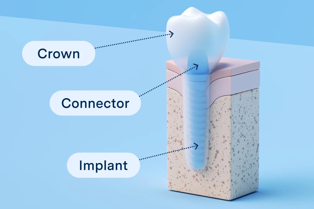 Dental Implants: Tooth Replacement Solution | Aspen Dental