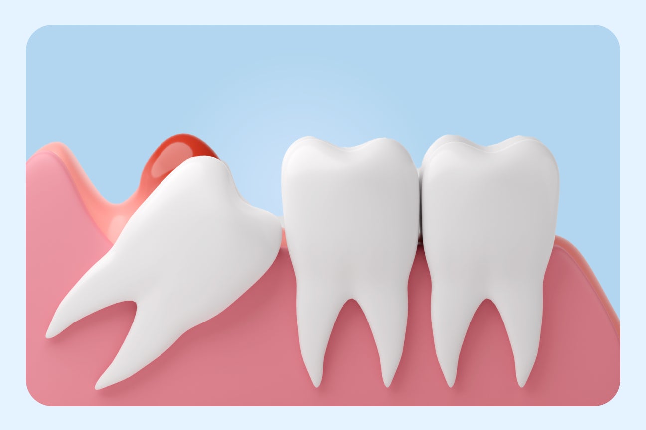 Tooth Extraction in Santa Maria, CA | Aspen Dental