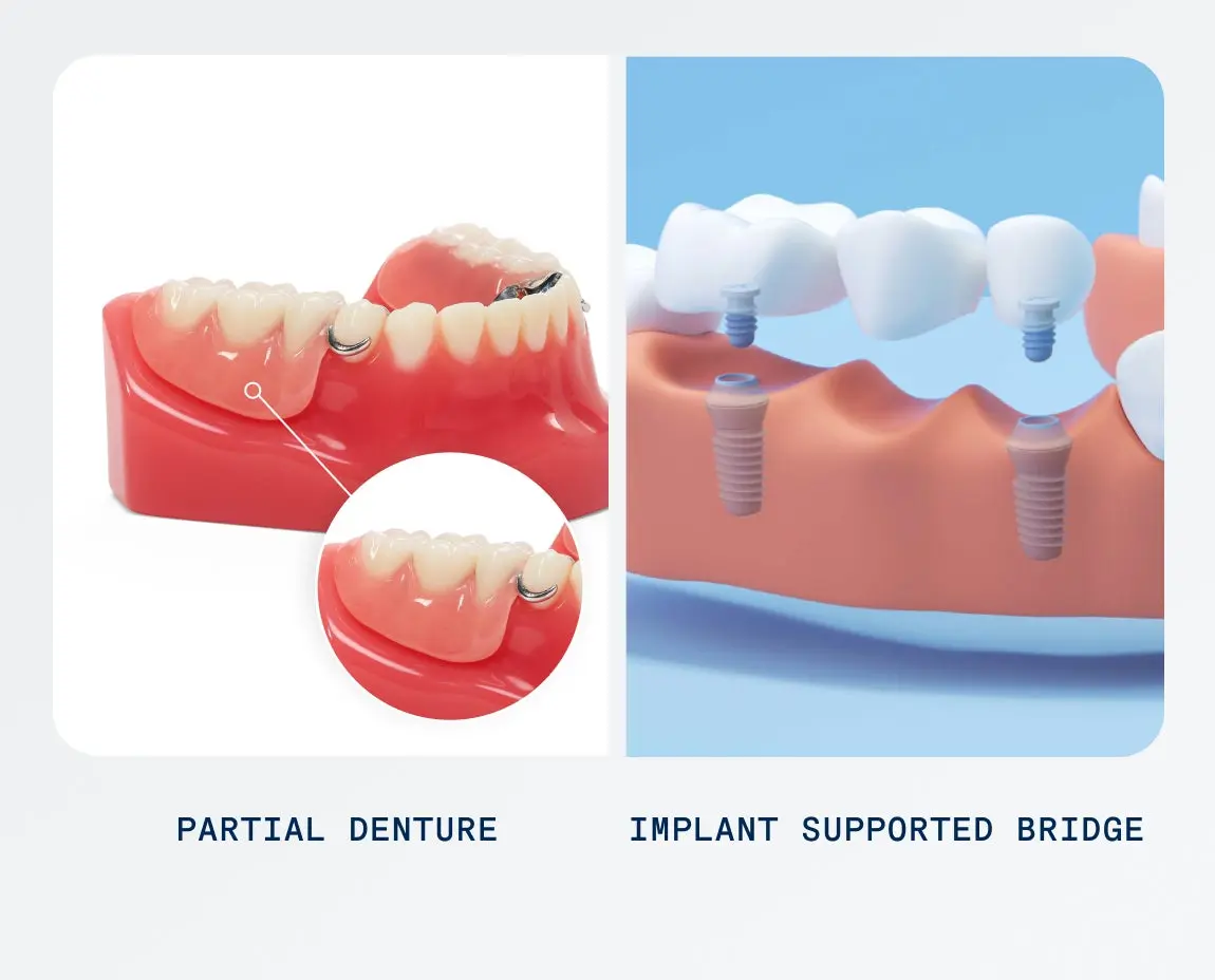 Benefits of upper and lower partial dentures | Aspen Dental