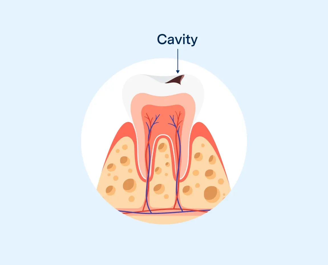 Why do cavities hurt and how can I prevent them? | Aspen Dental