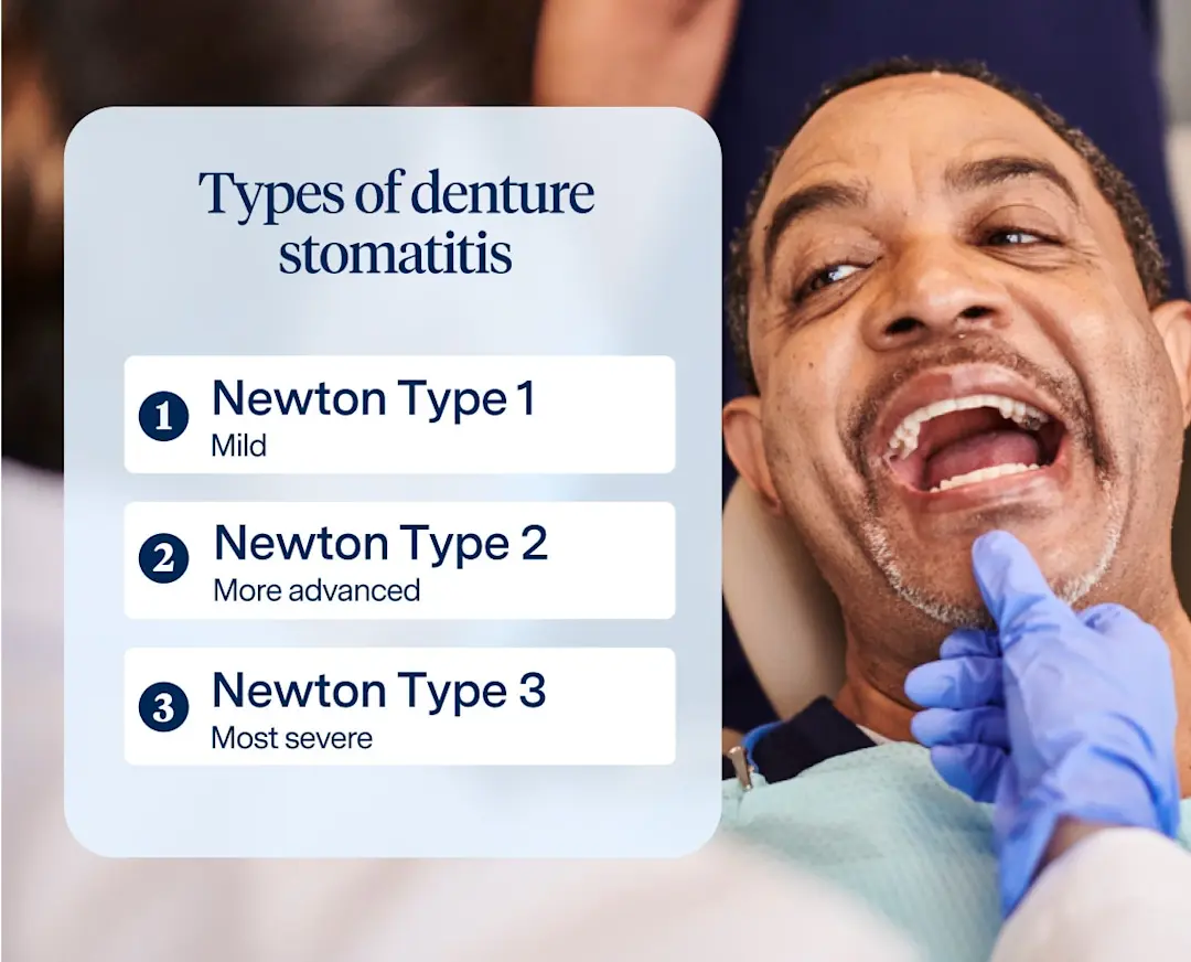 Denture stomatitis: causes, treatment and prevention | Aspen Dental